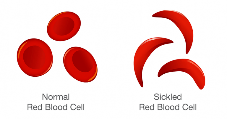 Sickle Cell Anemia and Sickle Cell Disease Types, Symptoms, Treatment