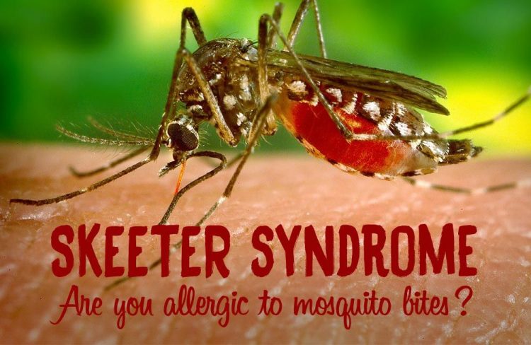Skeeter Syndrome: Allergic Reactions by Mosquito Bites - Bee Healthy