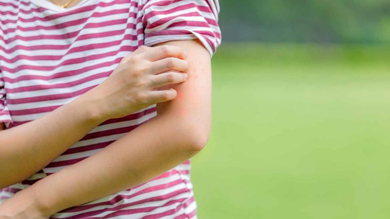 Skeeter Syndrome: Allergic Reactions by Mosquito Bites - Bee Healthy
