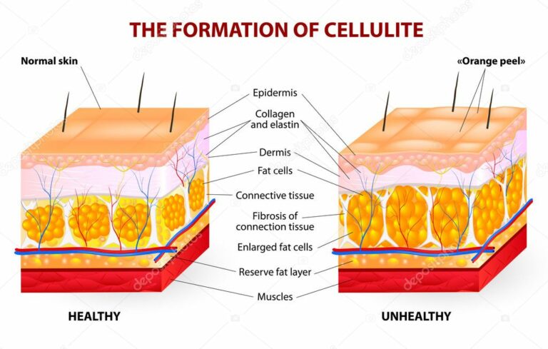 What is Cellulitis? Its Causes, Symptoms, Treatment - Bee Healthy