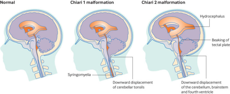All You Need to Know About Chiari malformations - Bee Healthy